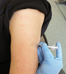 Allergy Testing - Allergy Associates of La Crosse